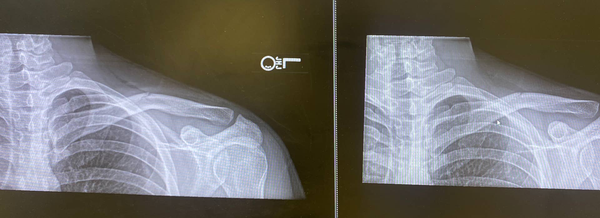 Recovering from Mountain Bike Injury: The Upside of Downtime