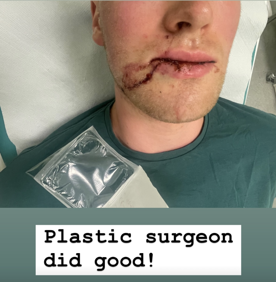 Two Mountain Bikers Hospitalized in Freak Accident