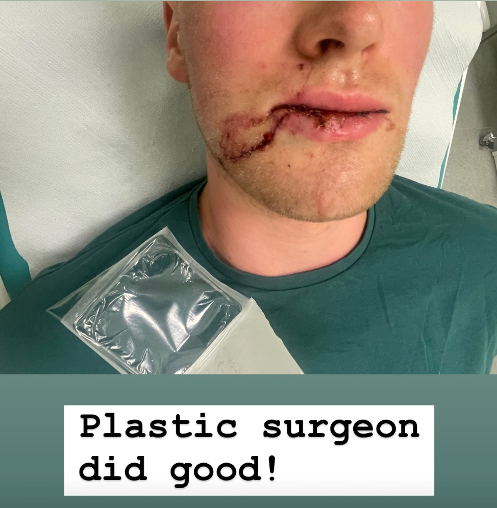 Two Mountain Bikers Hospitalized in Freak Accident - BikeMag